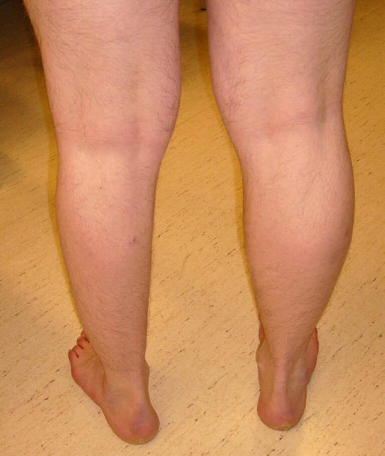 Treating Body Asymmetry with Postural Restoration - SIMIO Physical Therapy