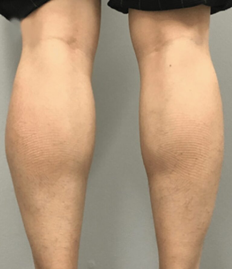 Treating Body Asymmetry with Postural Restoration - SIMIO Physical Therapy